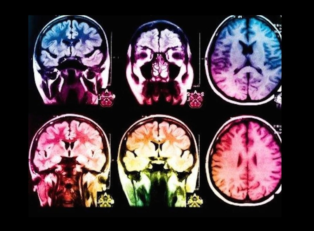 Brain-Dead People Could be 'Brought Back to Life,' Thanks to New ...