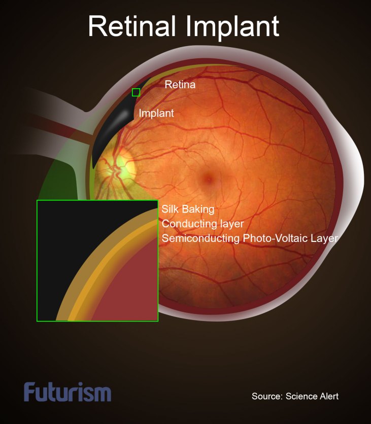 Retinal Implants Could Restore Sight to More Than 2 Million People