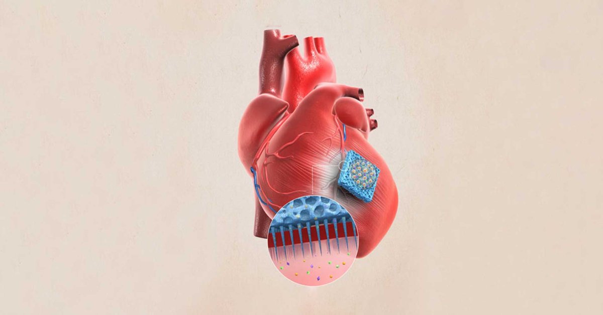 A Needle-Covered Patch Could Help Heal Damaged Hearts