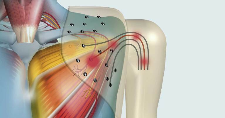 Doctors Wired a Prosthetic Hand Directly Into a Woman's Nerves