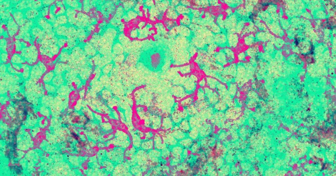 Scientists Intrigued by Clever Trick That Makes Cancer Cells Self-Destruct