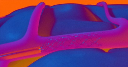 Neuralink Jamming Wires Deeper Into Second Patient's Brain