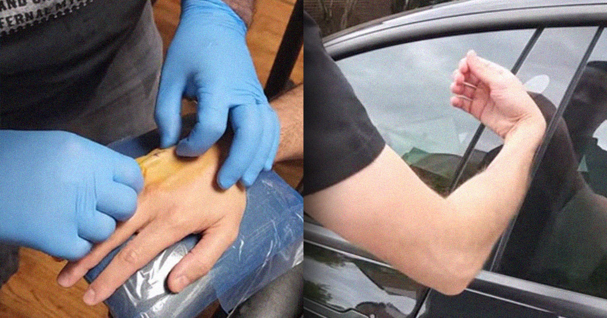 Tesla Enthusiast Implants Car Key Inside His Flesh