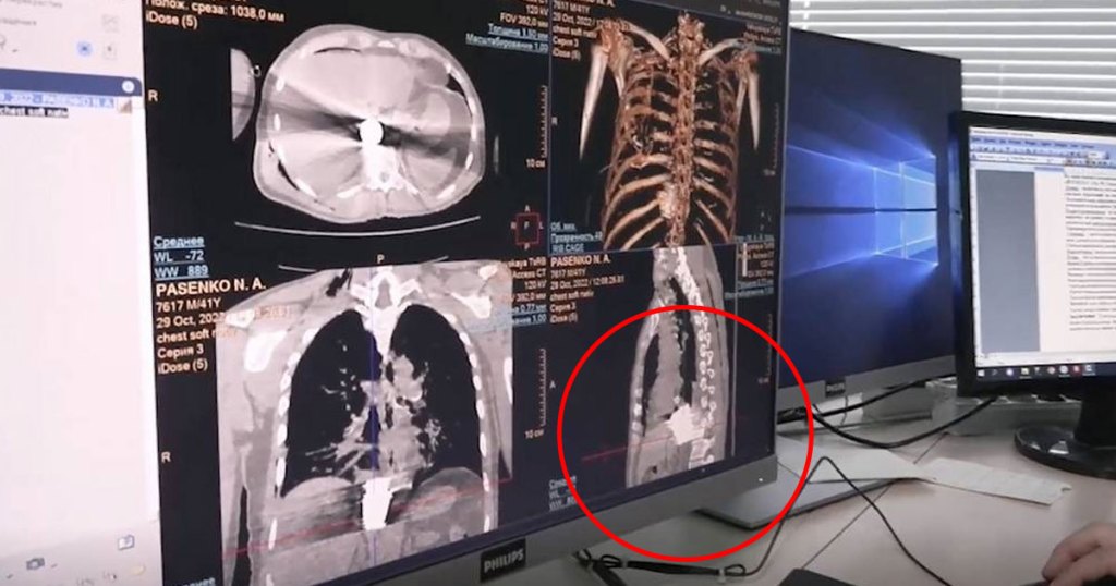 Unexploded Shell Removed From Soldier's Chest by Surgeons Wearing Body ...