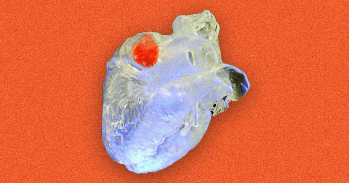 Doctors Invent New Way to 3D Print Inside the Body